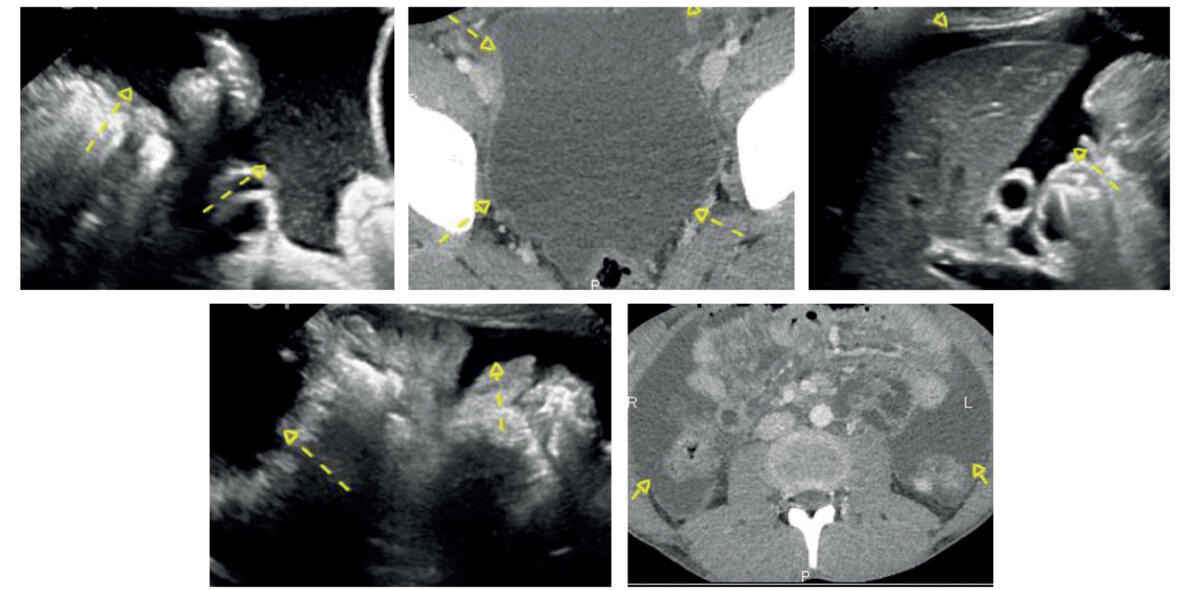 Tuberculose péritonéale : un défi diagnostique dans un monde en mouvement