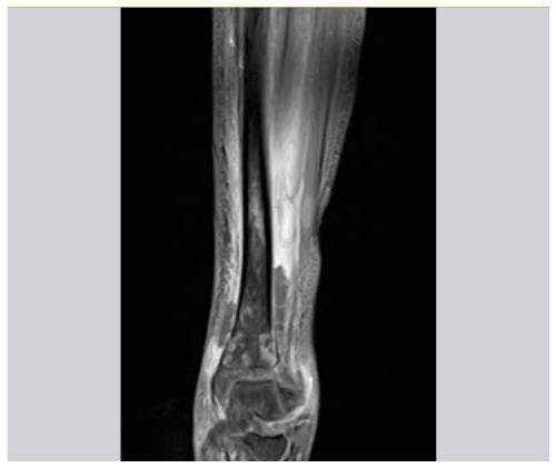 Infection à Staphylocoque Sur La Face Interne De La Cuisse
