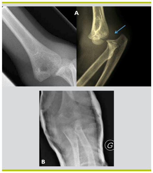 Approche minutieuse des fractures épiphysaires de l’humérus distal