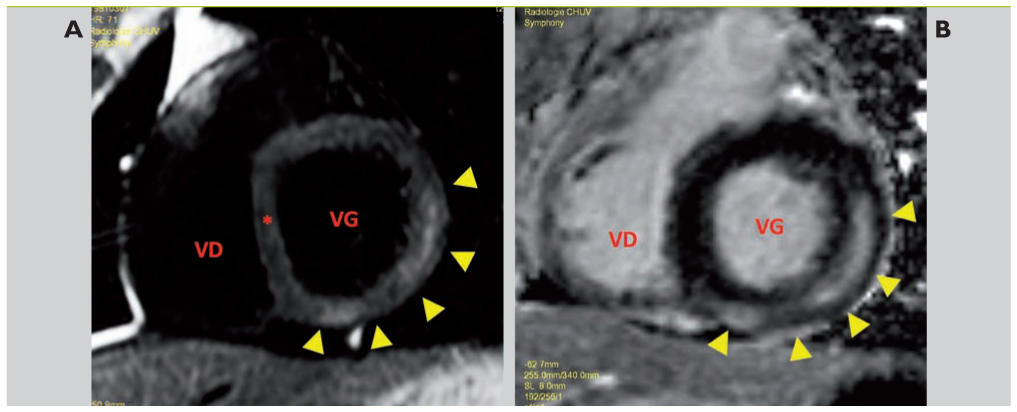 IRM De Péricardite Constrictive