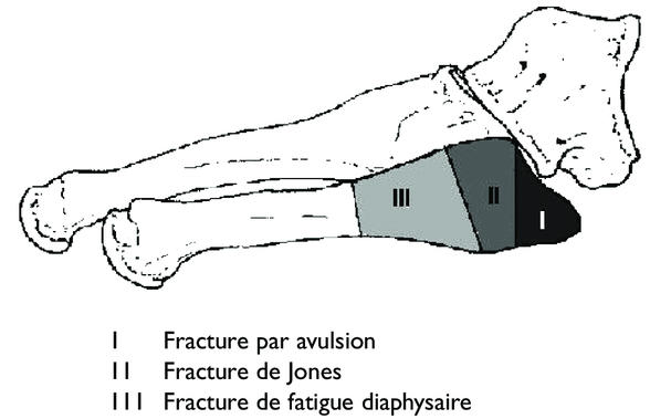 Traitement symptomatique des fractures non déplacées de la base du ...