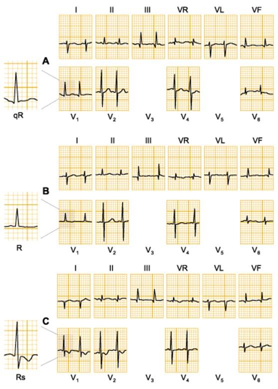 ECG Anormal à 12 Dérivations