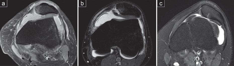 Instabilité rotulienne : diagnostic et traitement
