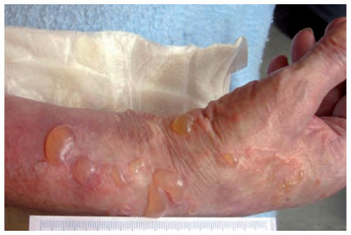 Pemphigoïde bulleuse : une dermatose du grand âge à mieux connaître