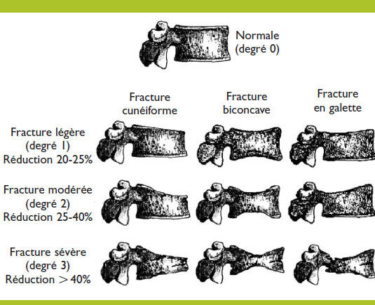 Fracture vertébrale évaluée par ostéodensitométrie. Un nouveau facteur ...