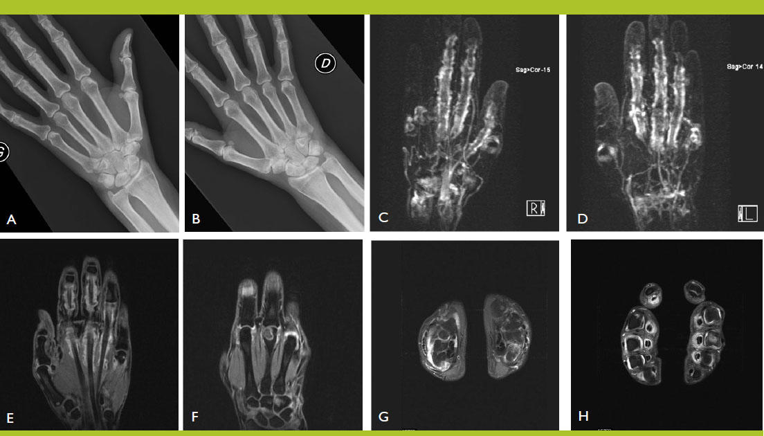 Radiographie De La Main Droite Normale Vue Du Film Radiographique