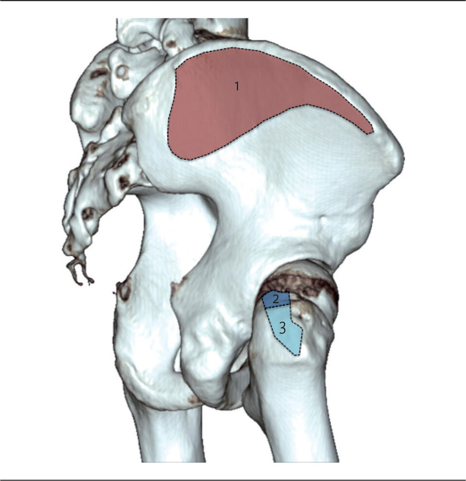 Quand opérer une rupture du tendon du moyen fessier