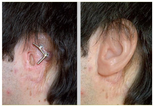 Syndrome Des Oreilles De Treacher Collins Allo Ortho » Naître Et