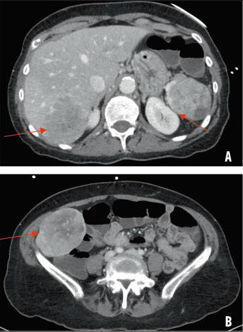 VIPome : étiologie rare d’une diarrhée hypokaliémiante