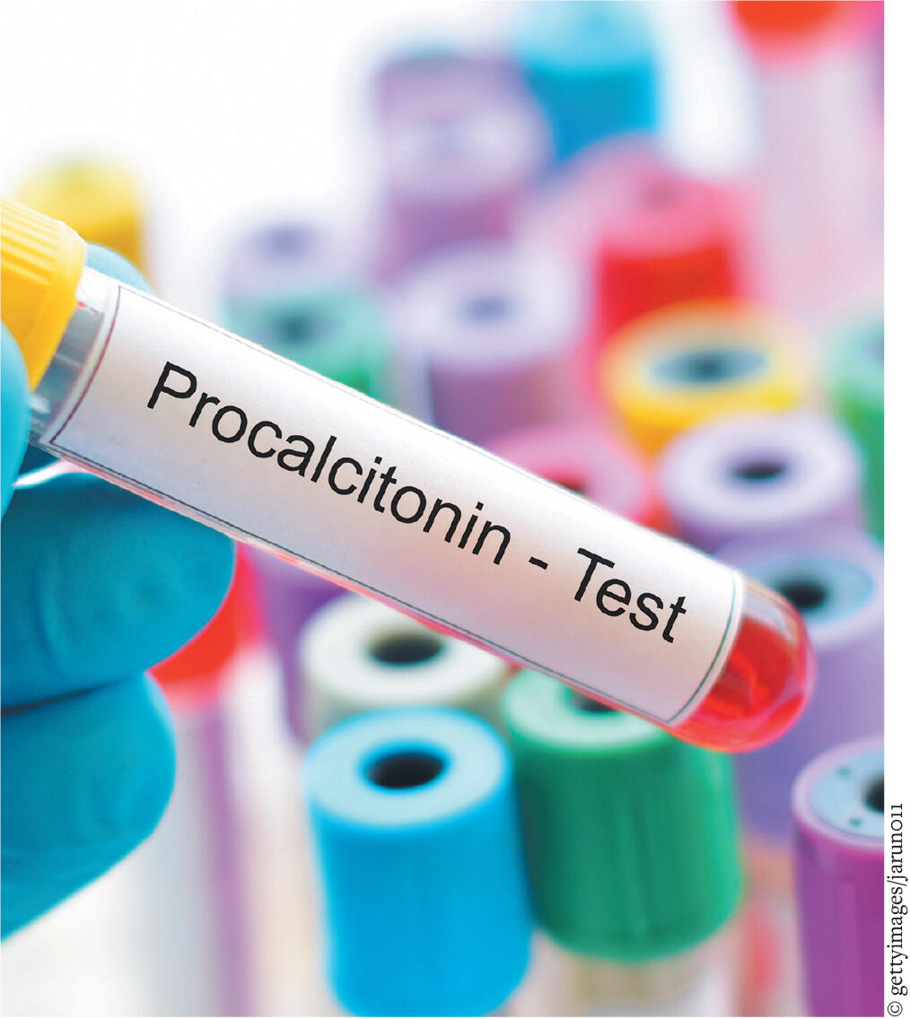 Anti ou procalcitonine?