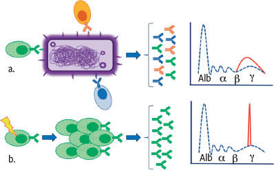 Gammapathies monoclonales: de la MGUS au myélome multiple