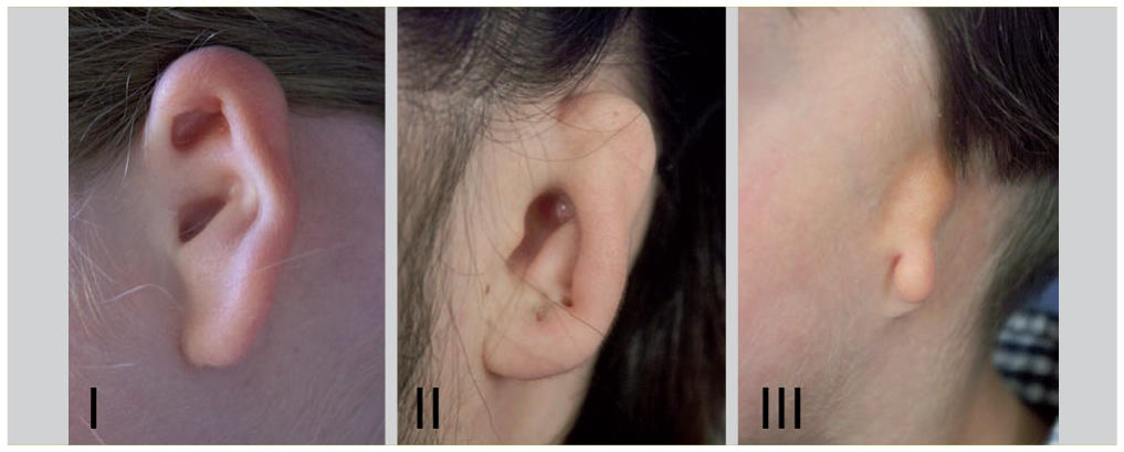 Reconstruction du pavillon de l’oreille en cas de microtie