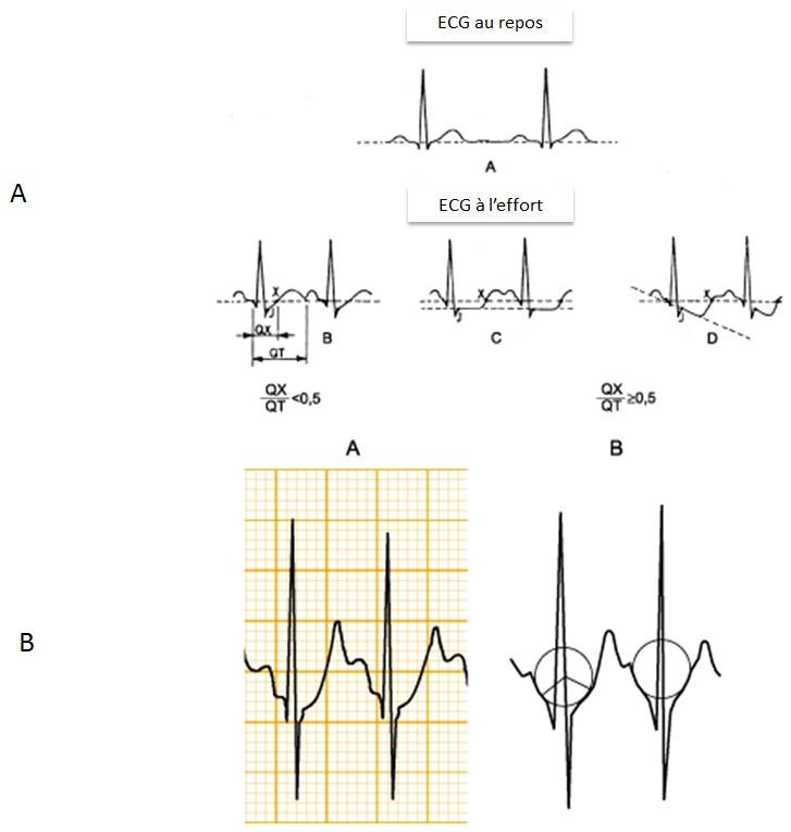 ECG Anormal à 12 Dérivations
