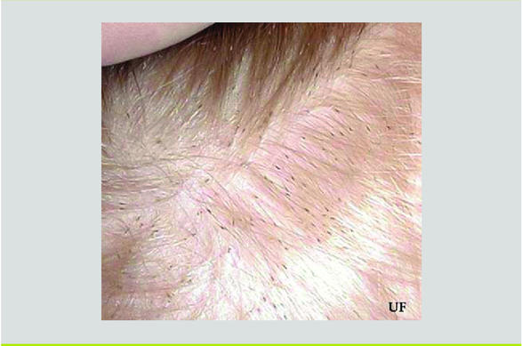 Poux Du Pubis Chez La Femme Les Poux Font Leur Rentrée Des Classes