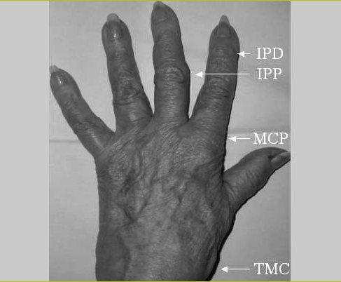 Présentation clinique, imagerie et traitement de l’arthrose digitale