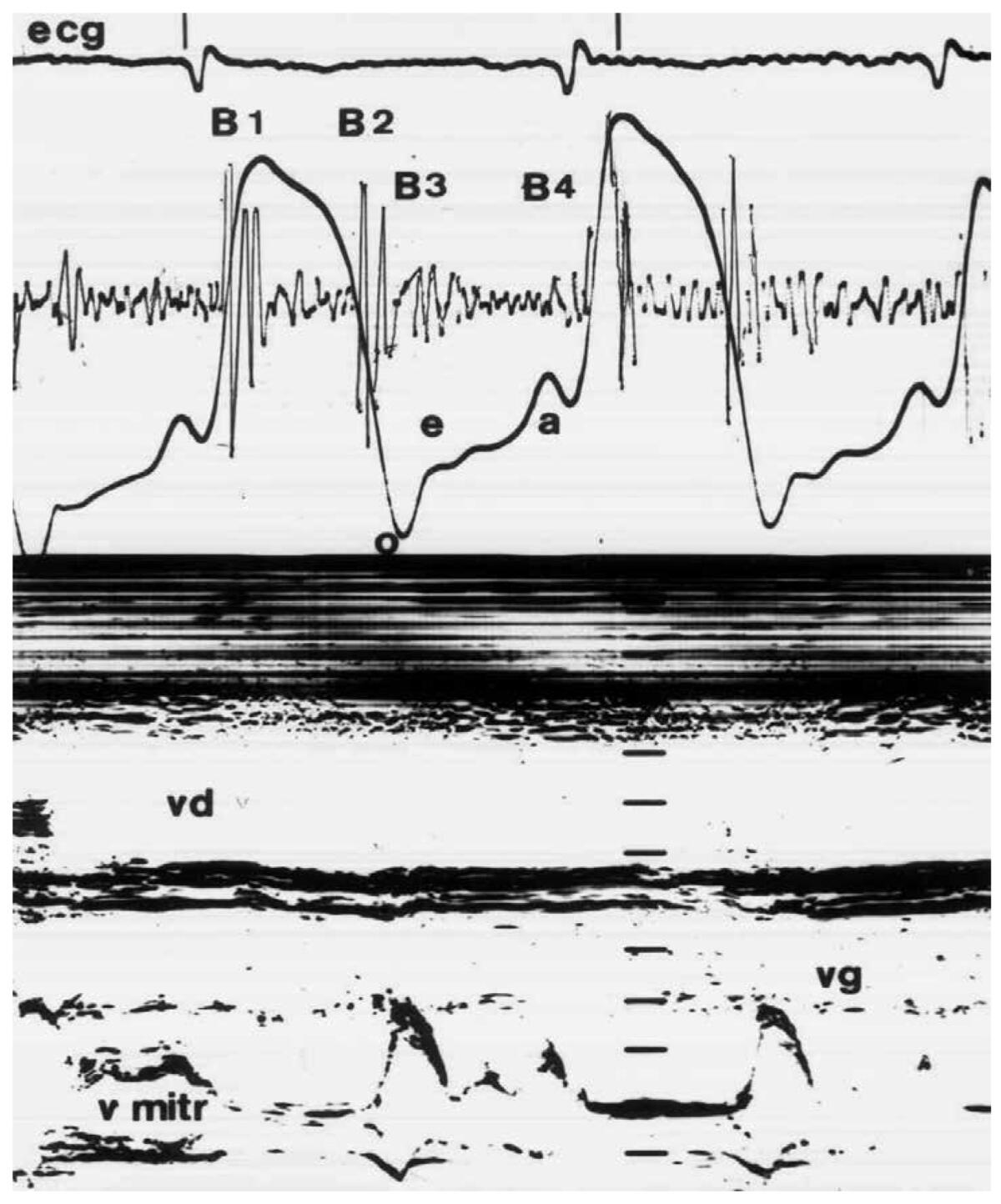Le troisième bruit (B3) et le quatrième bruit (B4) | CARDIOGERIATRIE ...