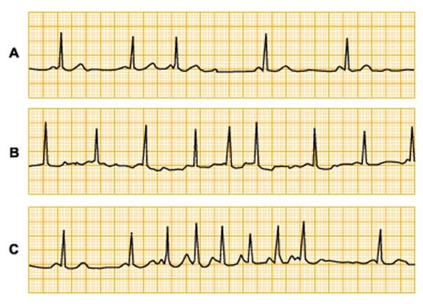 Extrasystoles Ventriculaires Complexe Ventriculaire