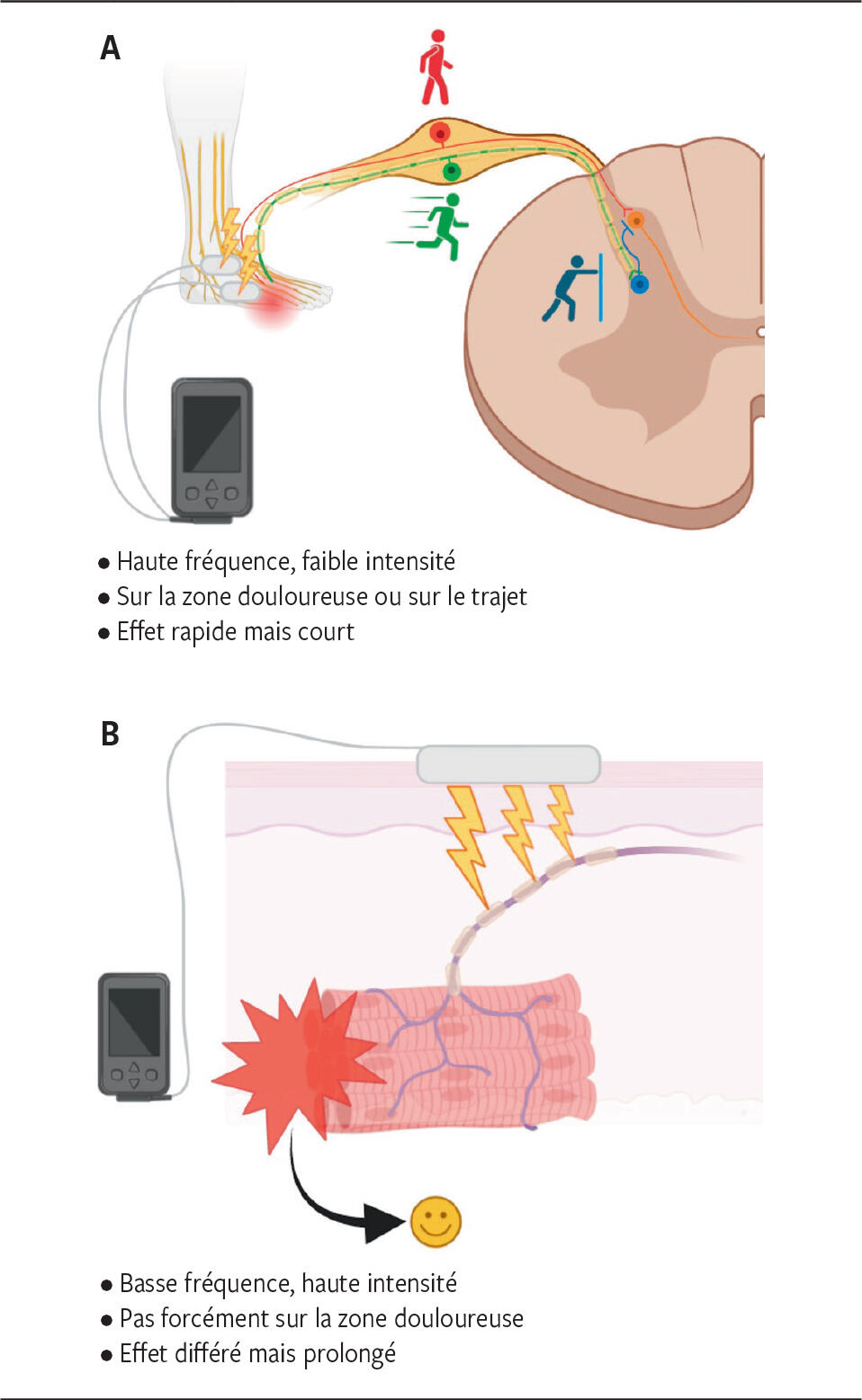 Douleur chronique : utilité de la neurostimulation électrique ...