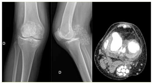Kyste Poplité 10 Traitements Naturels Contre Le Kyste Synovial