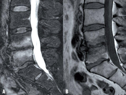 Quel est le rôle de la chirurgie pour les lombalgies avec des ...