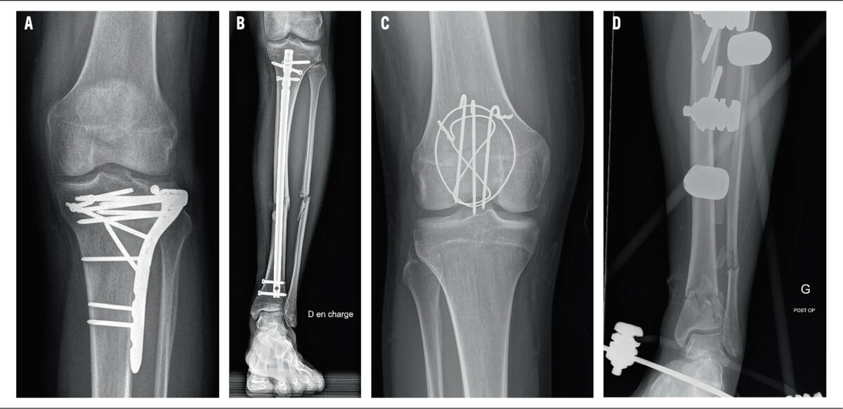 Ablation de matériel d’ostéosynthèse : une chirurgie à ne pas sous-estimer