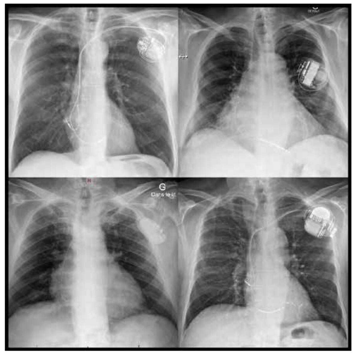 Types de pacemakers et défibrillateurs internes | CARDIOGERIATRIE ...