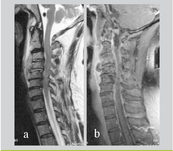 Spondylodiscite infectieuse: approche chirurgicale