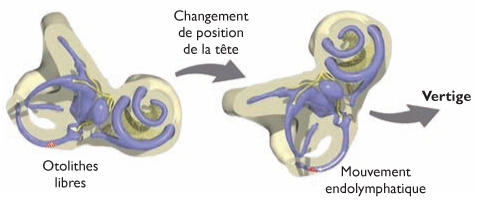 Traitement chirurgical du vertige positionnel paroxystique bénin