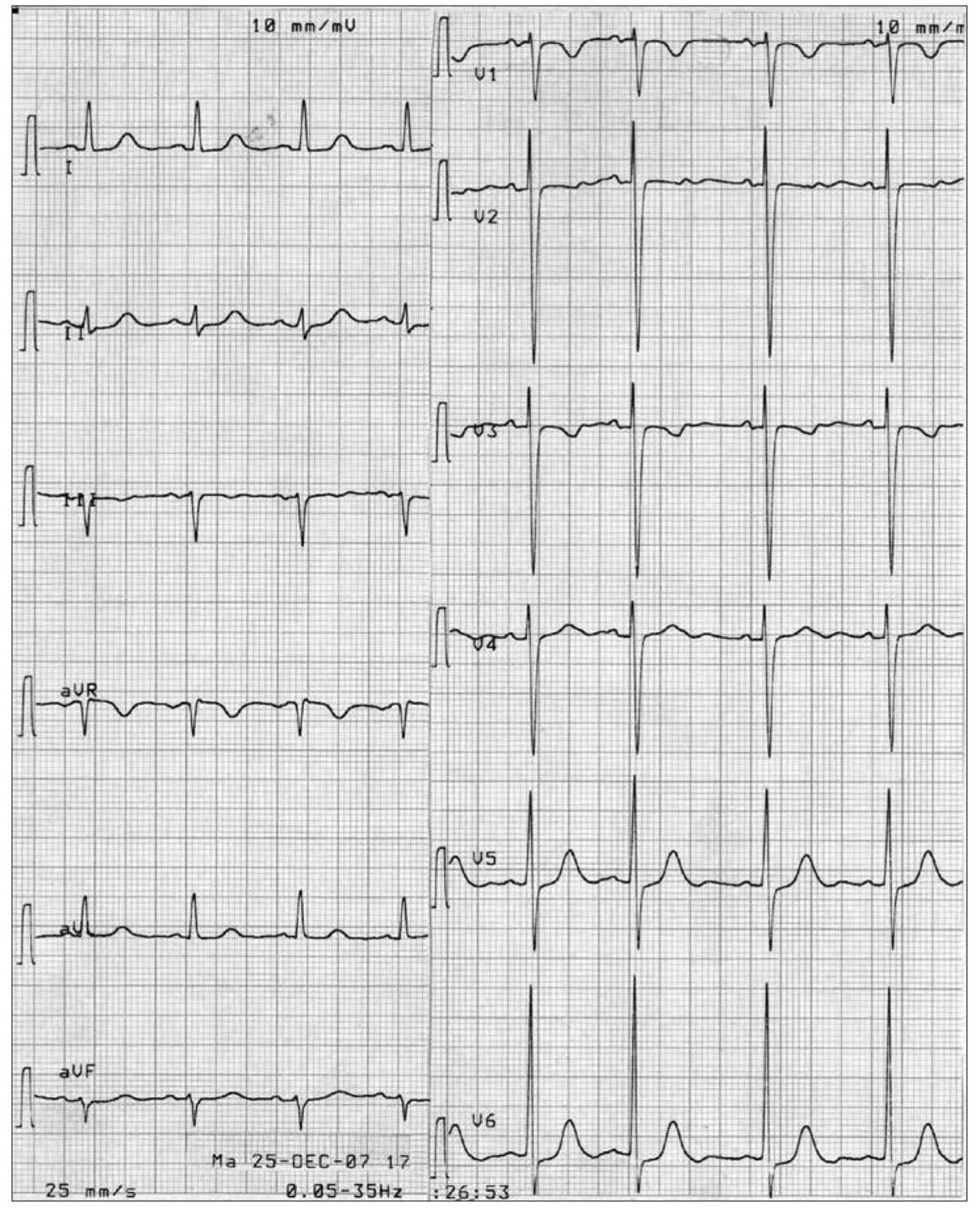 La masse musculaire ventriculaire | CARDIOGERIATRIE CLINIQUE A L'USAGE ...