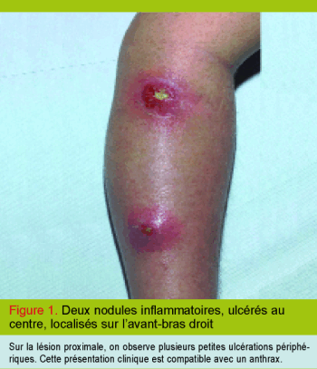 Infections cutanées sévères à Staphylococcus aureus producteur de ...