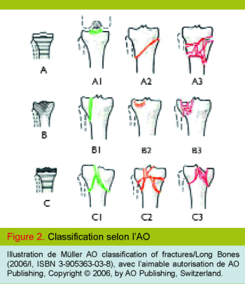 Tibial Plateau Fracture Classification : Tibial Plateau Fracture ...