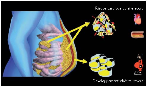 Répartition du tissu adipeux : implications cliniques - Revue Médicale ...