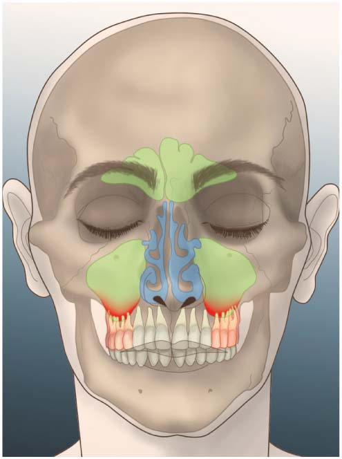 Les sinusites d’origine dentaire : diagnostic et prise en charge ...