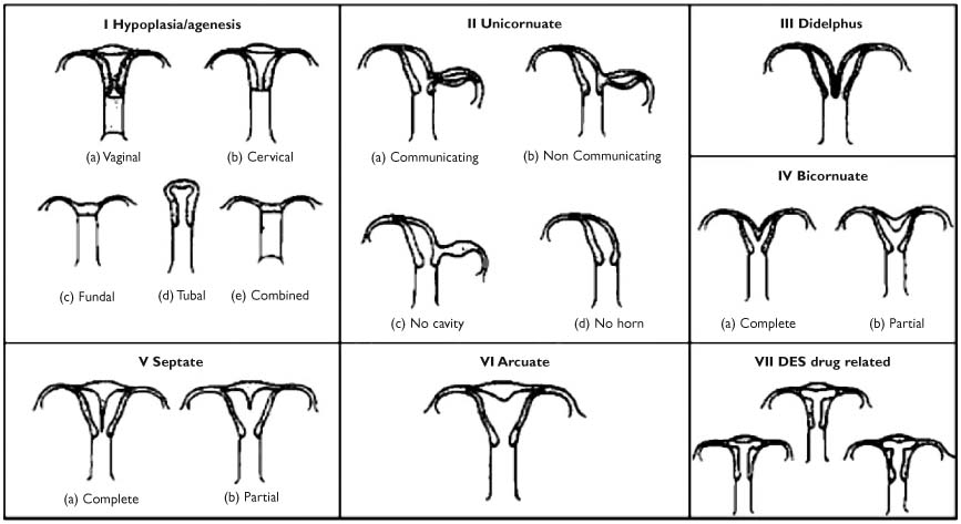 Les malformations utérines : diagnostic, pronostic et prise en charge ...