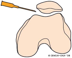 Ponctions et infiltrations articulaires - Revue Médicale Suisse