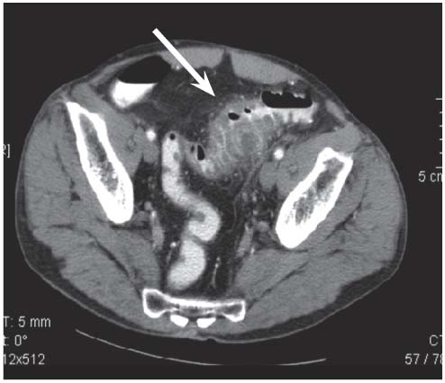 Traitement de la diverticulite sigmoïdienne - Revue Médicale Suisse