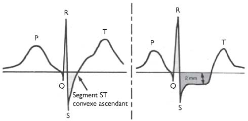epreuve d'effort mets