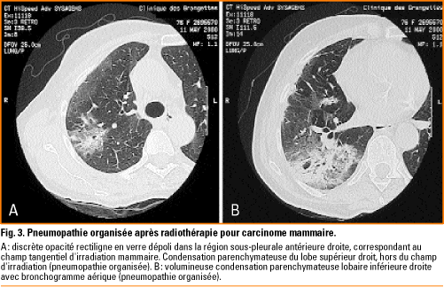 Pneumopathie organisée - Revue Médicale Suisse