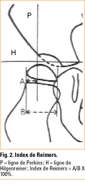 La hanche paralytique - Revue Médicale Suisse
