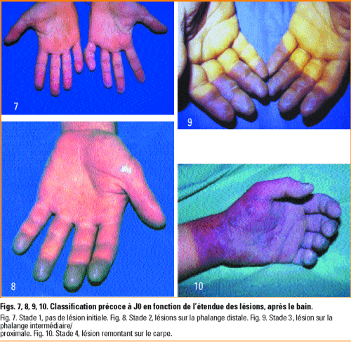 Gelures des extrémités. Mise à jour et prise en charge - Revue Médicale ...