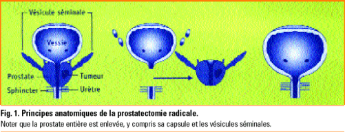 La prostatectomie radicale - Revue Médicale Suisse