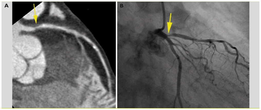 Le CT-scan des artères coronaires en pratique clinique courante - Revue ...