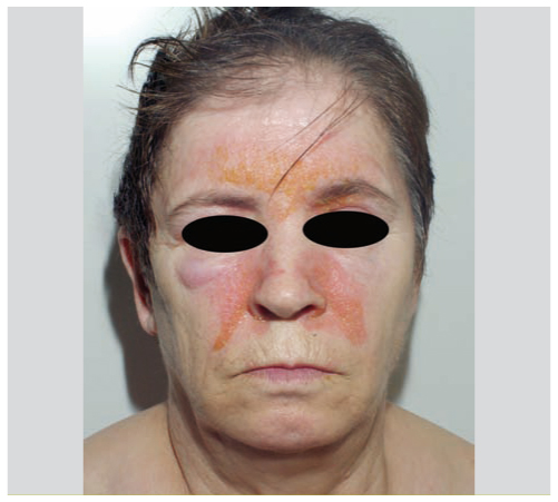 Dermite séborrhéique : manifestations cliniques et prise en charge ...