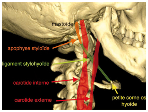 Carotidynie et syndrome d’Eagle : deux syndromes classiques à ...