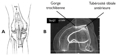 Diagnostic et traitement de l’instabilité rotulienne - Revue Médicale ...