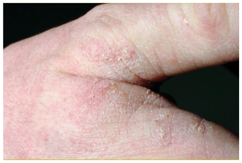 La gale en 2012 - Revue Médicale Suisse