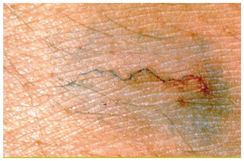 La gale en 2012 - Revue Médicale Suisse