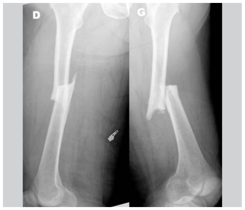 Fracture atypique du fémur sous bisphosphonates, un effet indésirable à ...