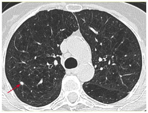 Dépistage du cancer pulmonaire par scanner thoracique - Revue Médicale ...