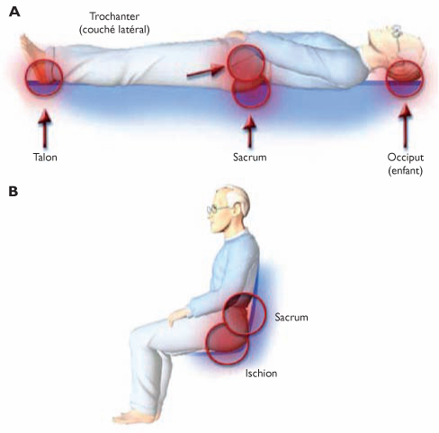 Personne âgée et escarres : prévention et traitement - Revue Médicale ...